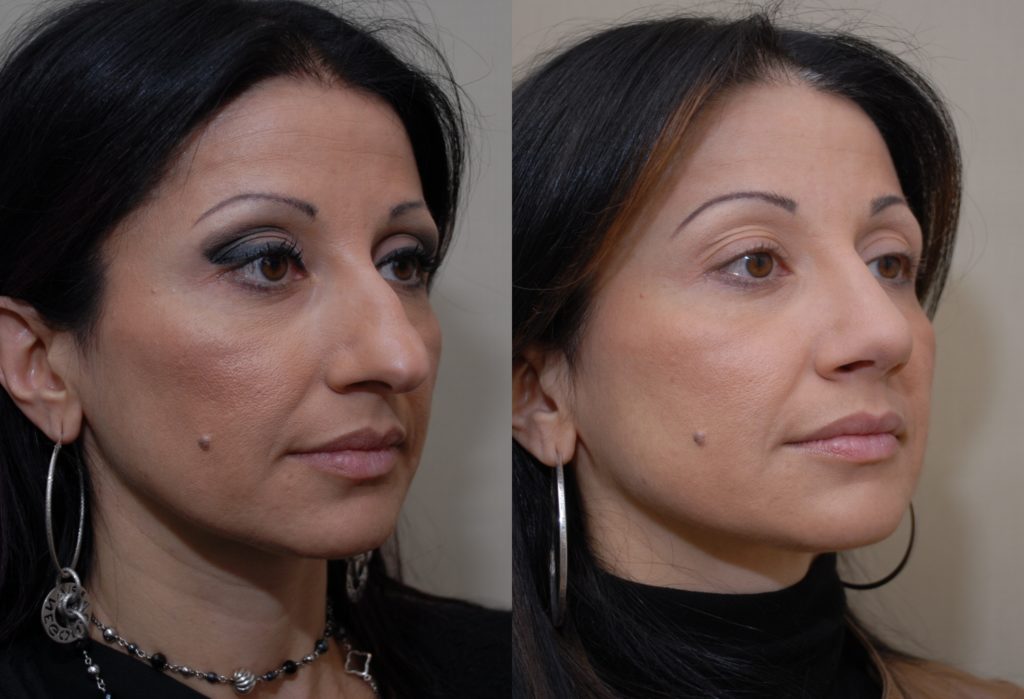Nose Jobs / Rhinoplasty