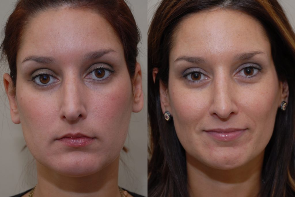 Nose Jobs / Rhinoplasty